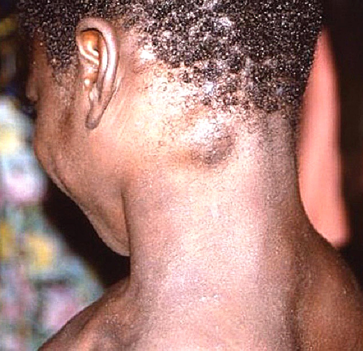 3 sự khác biệt giữa người lớn và trẻ em khi mắc đậu mùa khỉ - Tuổi Trẻ ...