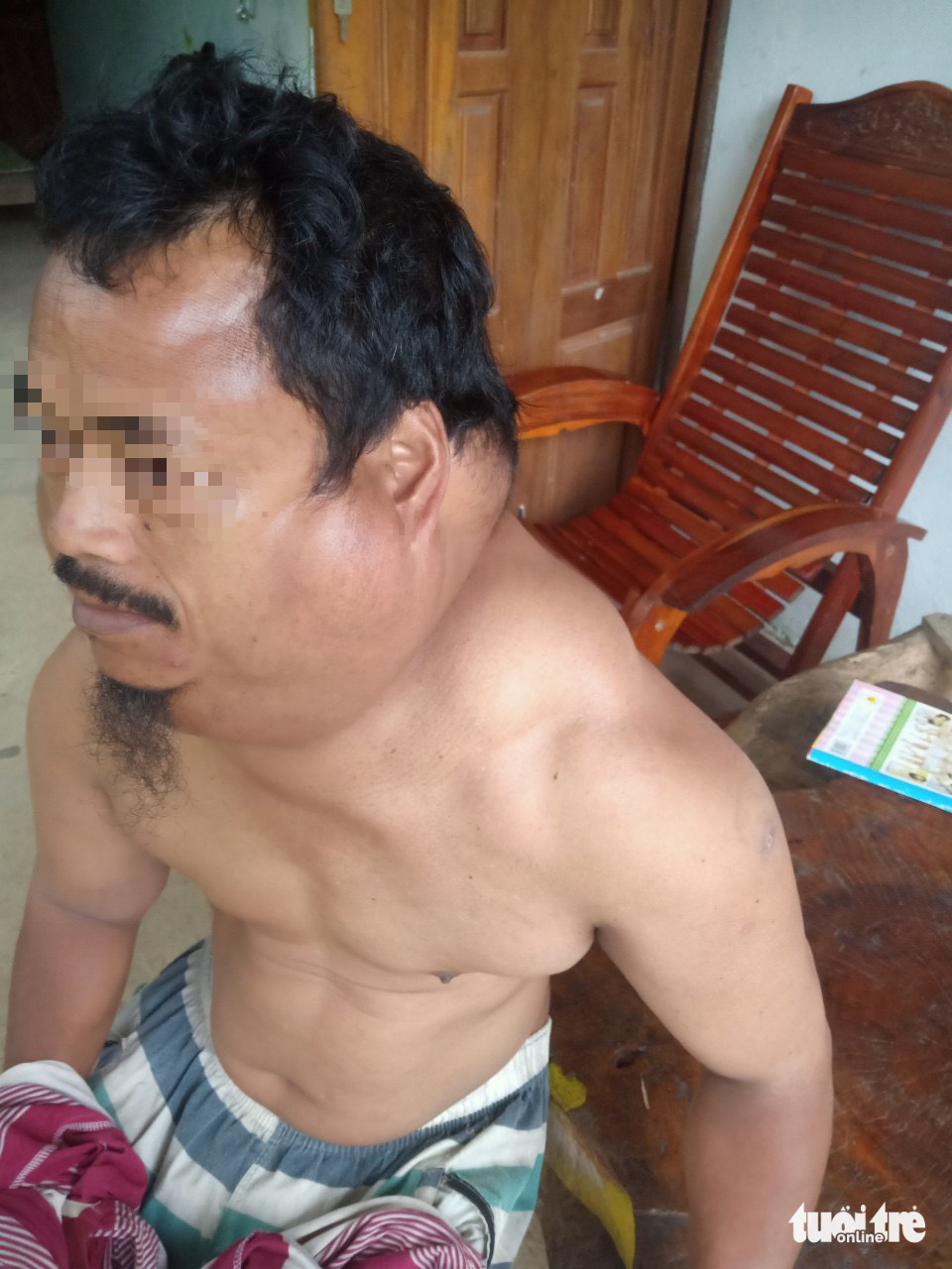 Phẫu thuật khối u 4kg cho 'người cổ gấu' - Tuổi Trẻ Online