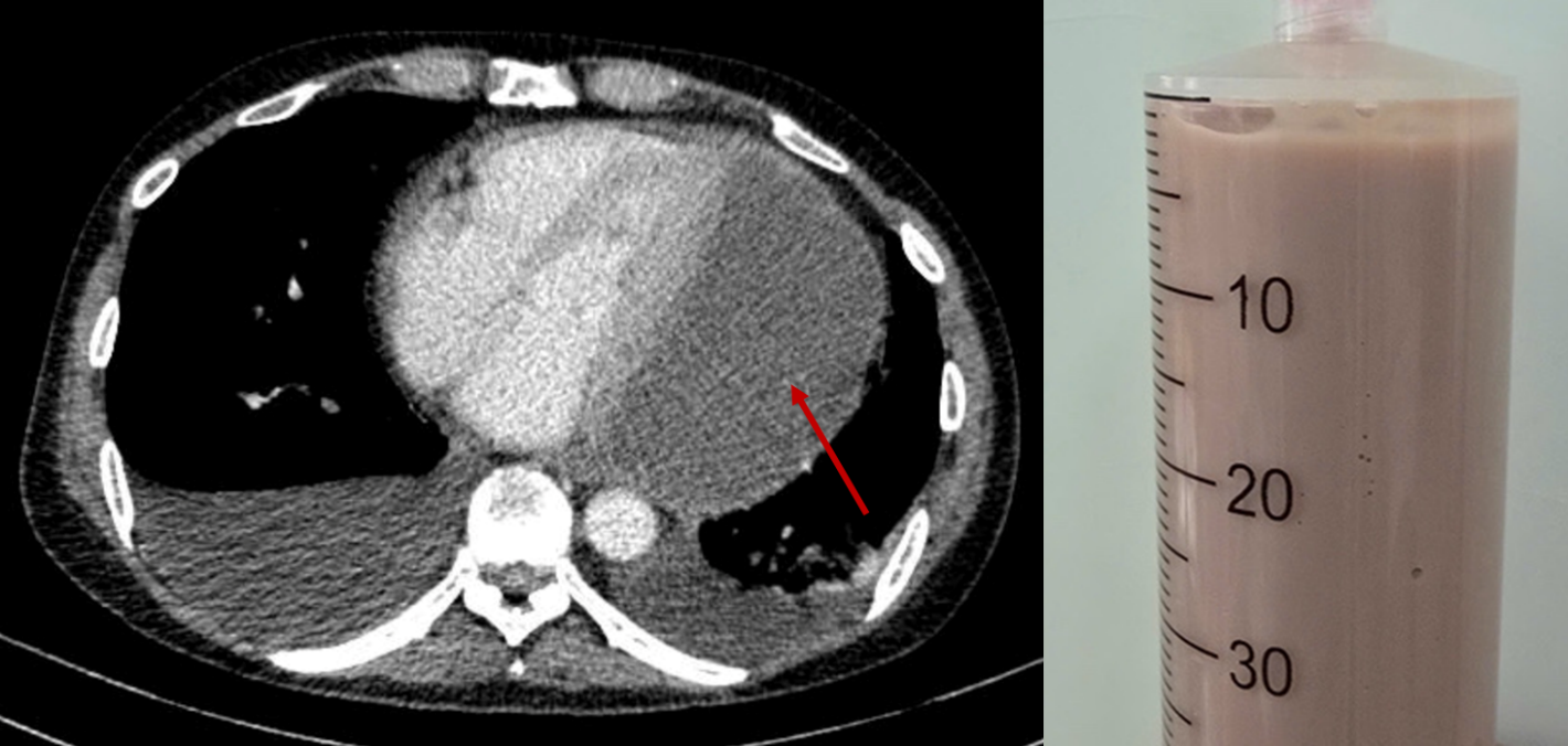 Bệnh viện 115 cứu người bị hơn 500ml dịch mủ quanh tim, ca bệnh hiếm ...