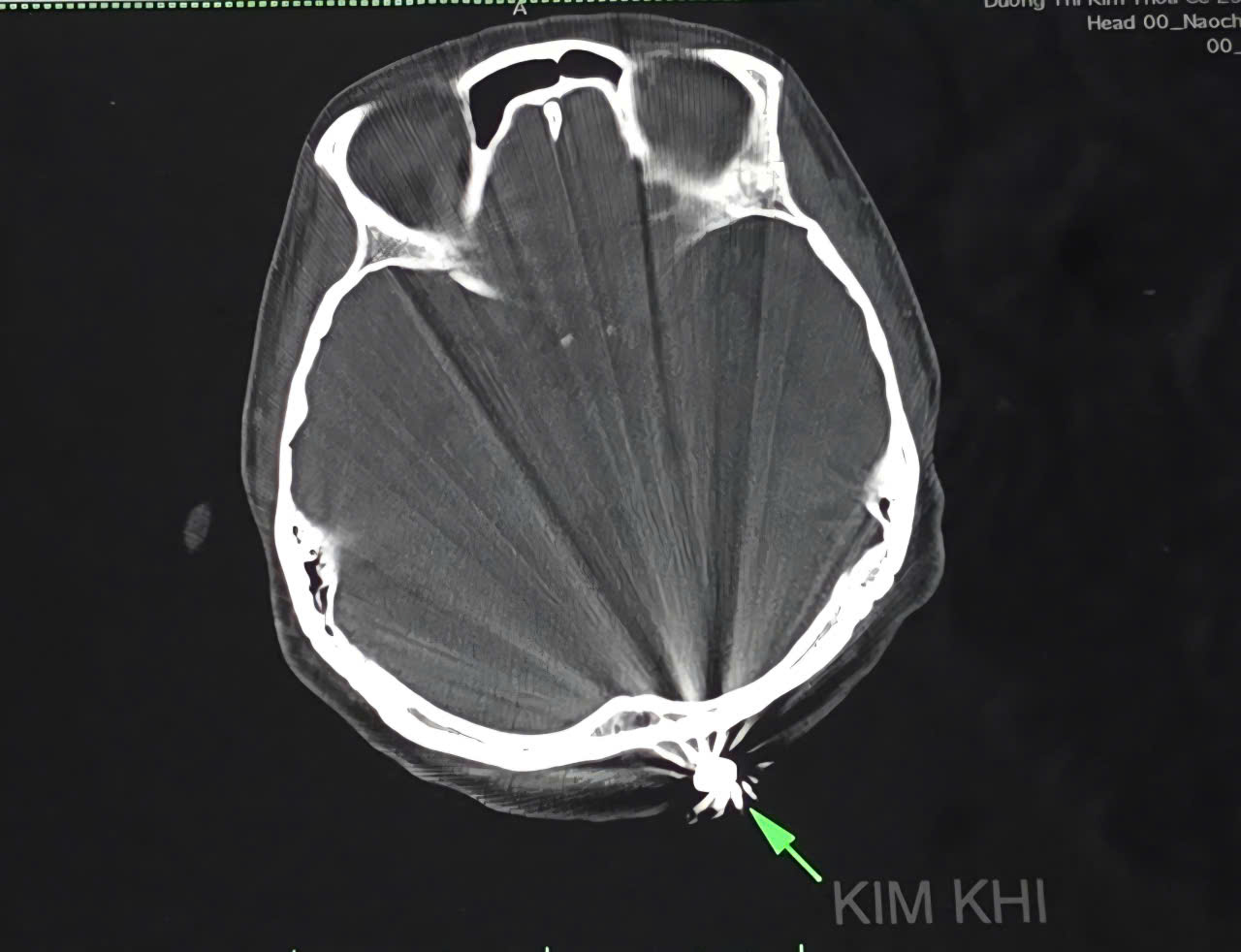 Vietnamese woman survives stray bullet to head while gardening