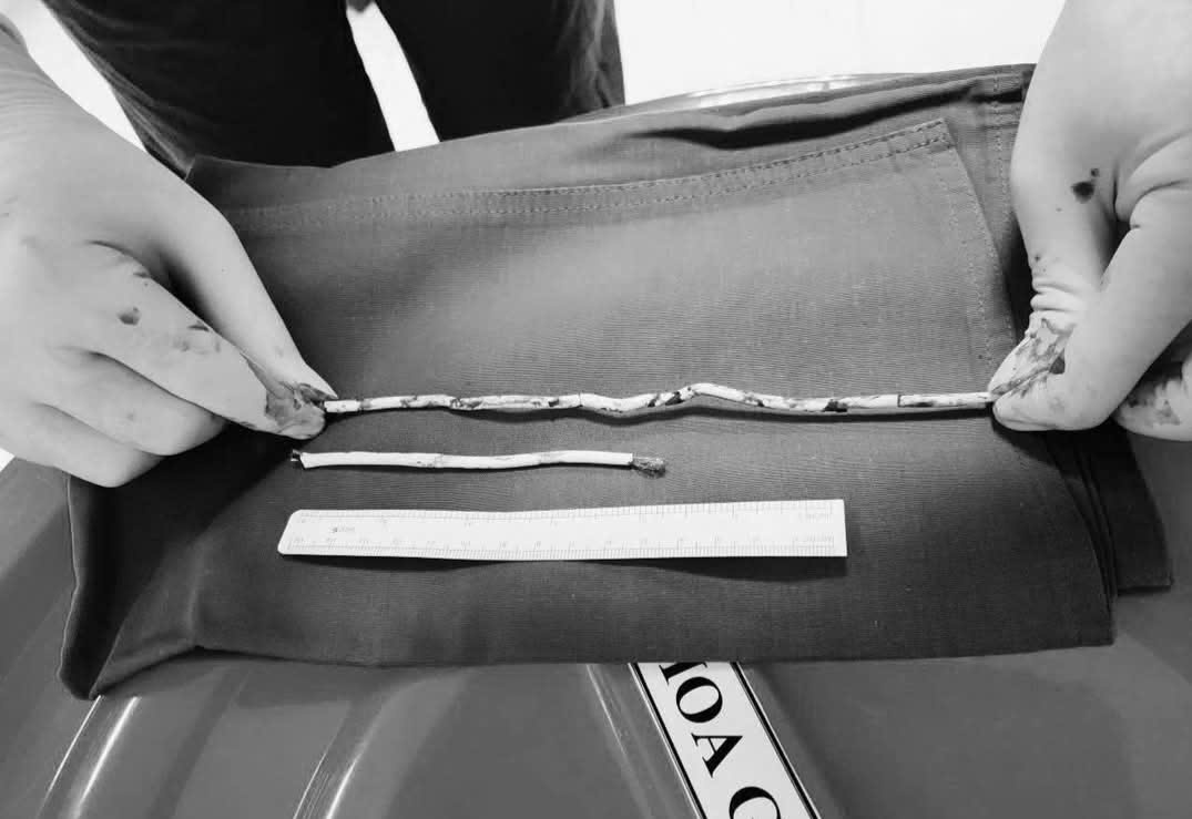 Boy hospitalized after string inserted into urethra, following online ...