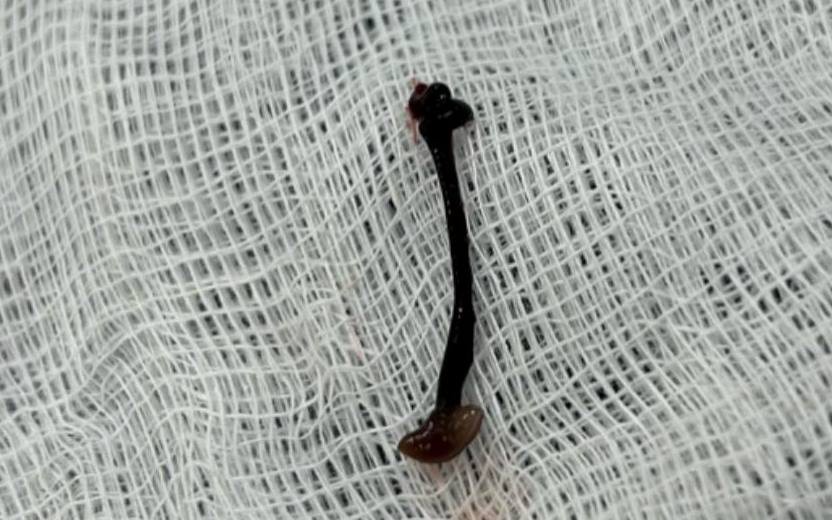In Vietnam, doctors find 12cm leech living in 8-year-old boy’s airway