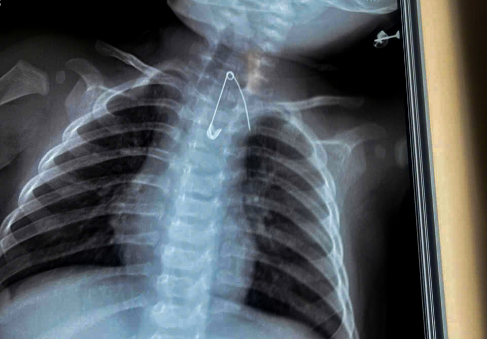Vietnam hospital saves 2 children who swallowed safety pin, lollipop stick