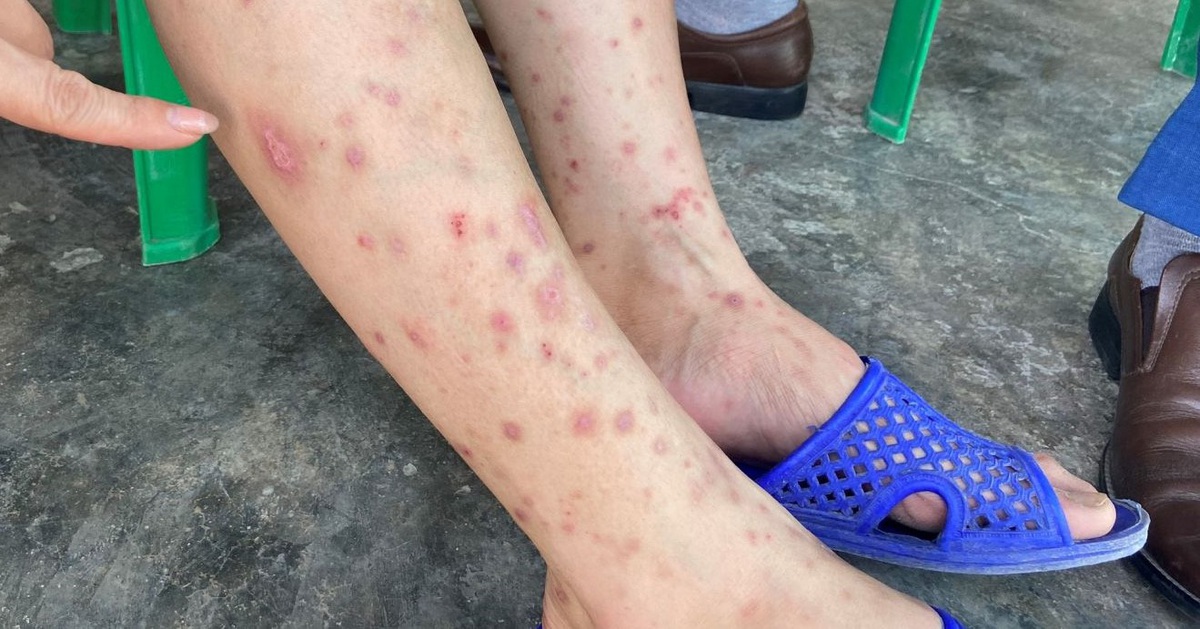 Bọ chét hút máu khiến gần 160 người bị viêm da dị ứng - Tuổi Trẻ Online