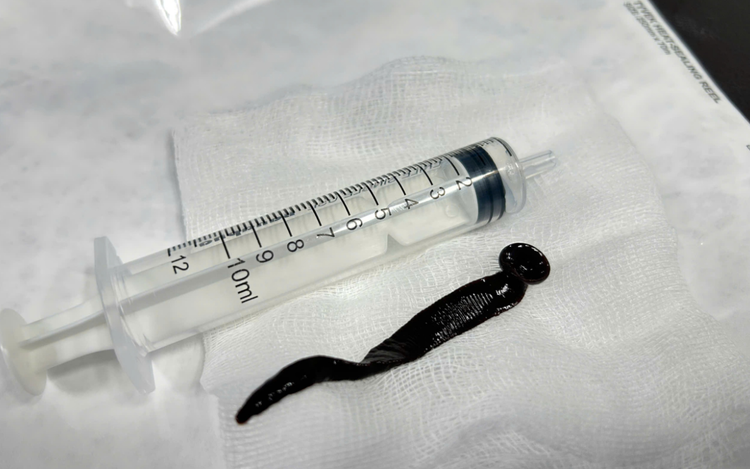 In Vietnam, doctors find 12cm leech living in 8-year-old boy’s airway