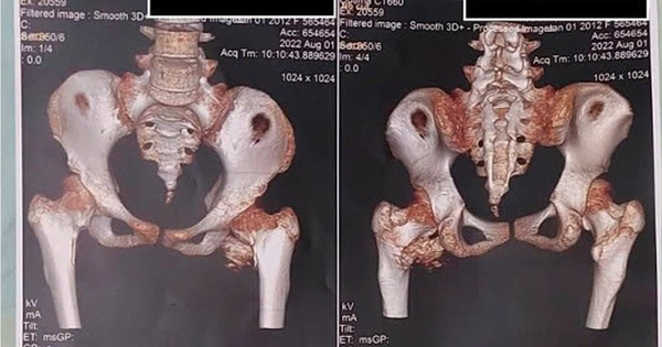 Rare stone man syndrome diagnosed in 12-year-old girl in Ho Chi Minh City