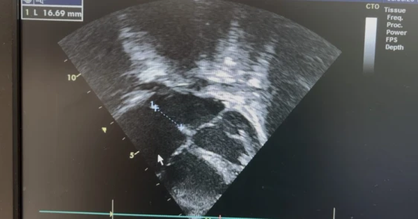 Ho Chi Minh City doctors close large heart defect in Cambodian girl