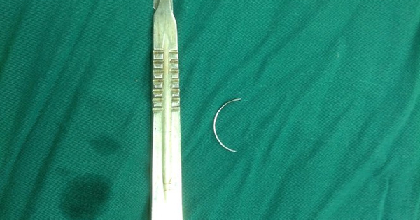 Vietnam man lives 15 years with surgical suture in stomach