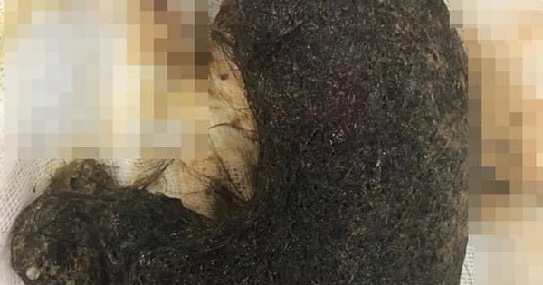 Vietnamese tween has huge hairball removed from stomach