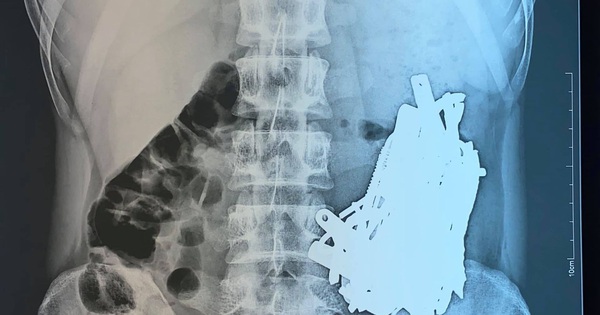 Vietnam doctors remove 1kg of metal objects from patient with pica disorder