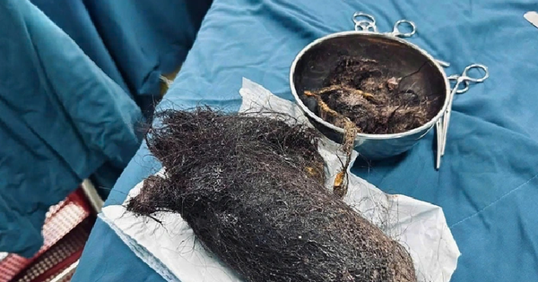 900gr hairball removed from 12-year-old Vietnamese girl’s stomach